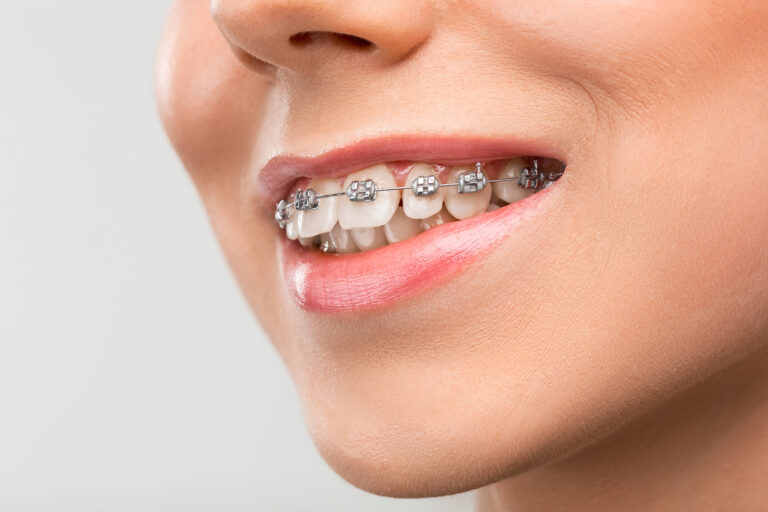The facts behind braces: How do they work? - Houston Dentistry Care